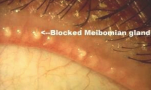 Dry Eye Solutions - Southland Eye Clinic